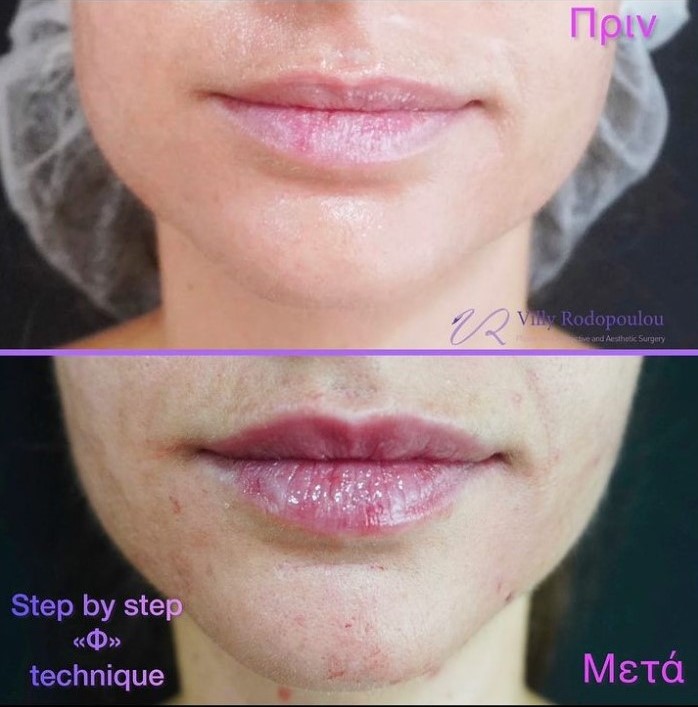 Φυσική τόνωση και αρμονία στα χείλη με τη Step by step Φ technique ...